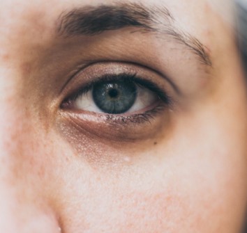 Wie entstehen Augenringe? | Grund für Augenringe | Optical Express